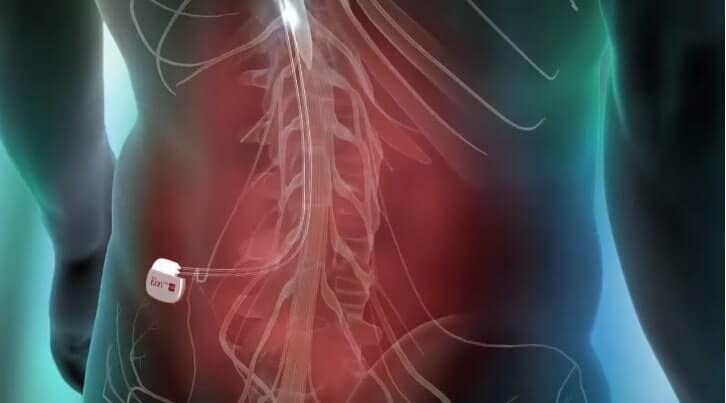 Infographic: Chronic Pain. An Invisible Condition | PainScale