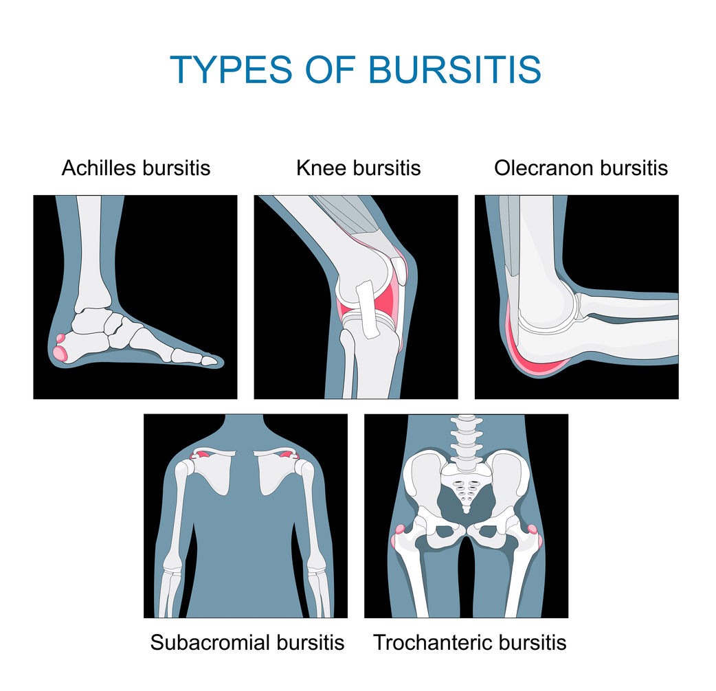 Types Of Bursitis PainScale