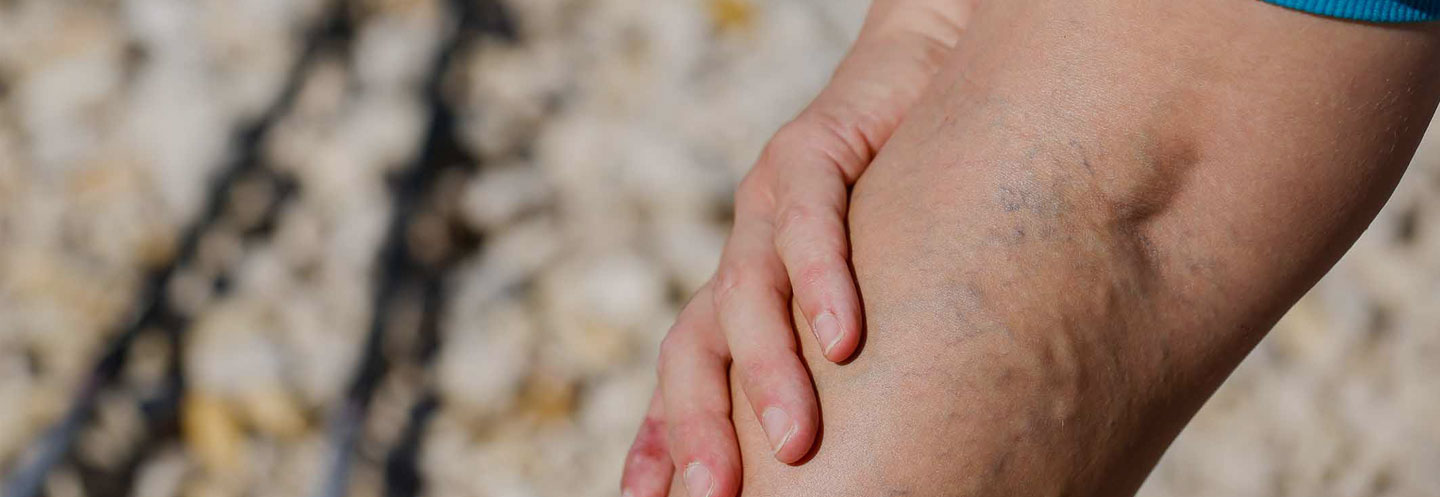 Peripheral Vascular Disease Leg Pain